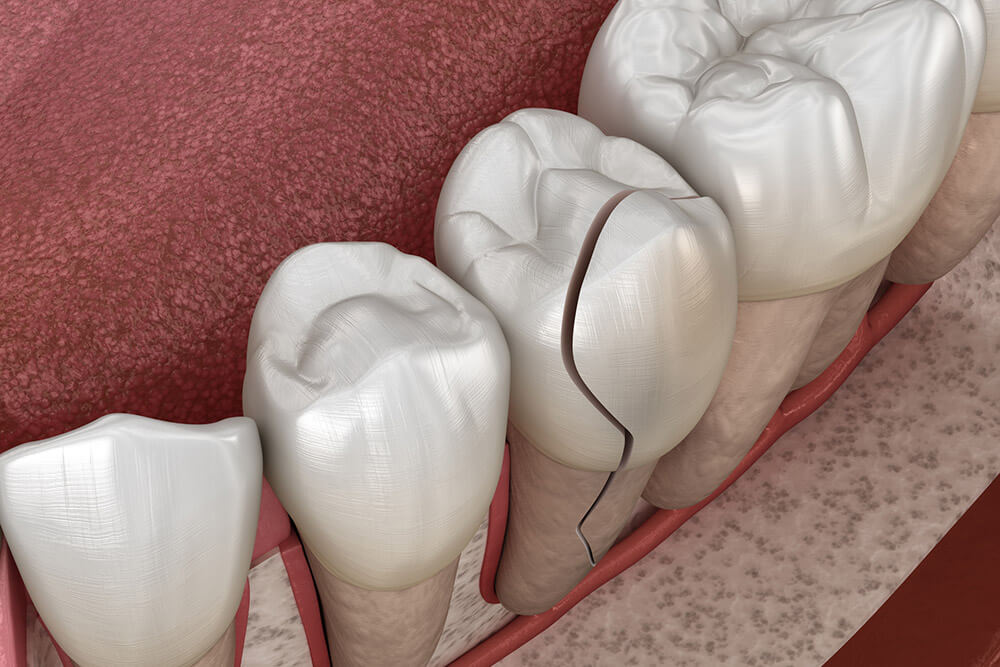 How to Know If Your Tooth’s Enamel Is Damaged - Drum Hill Dental